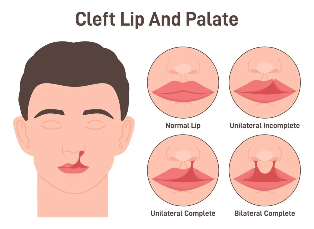 Cleft Lip Chandler & San Tan Valley AZ | Cleft Palate Chandler AZ